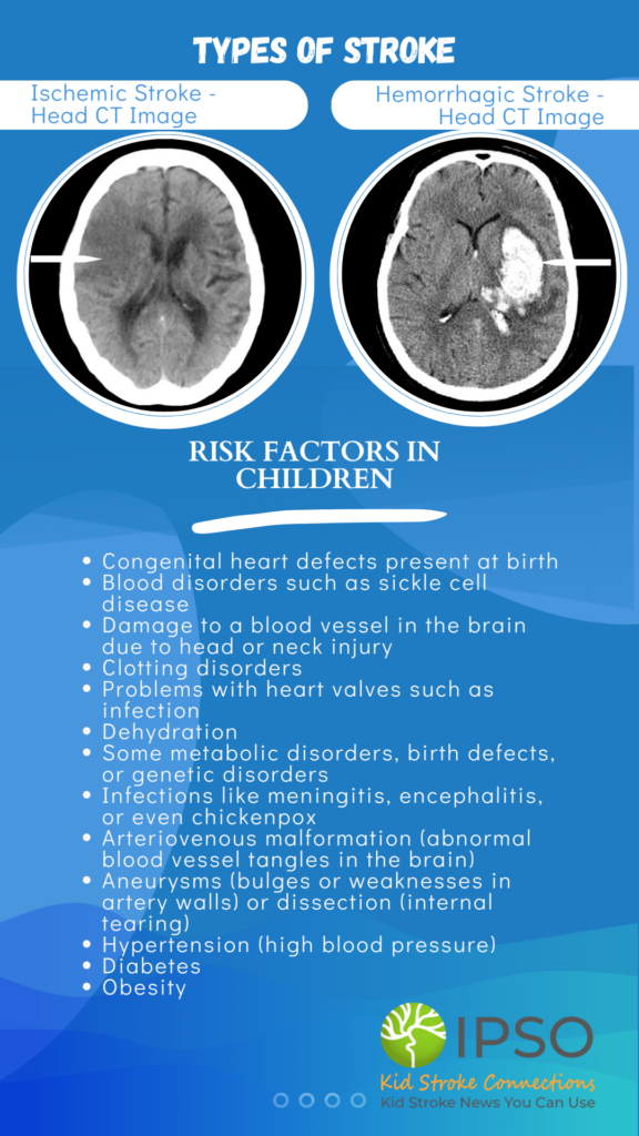 Stroke in Children: Warning Signs & How to Help - community ...